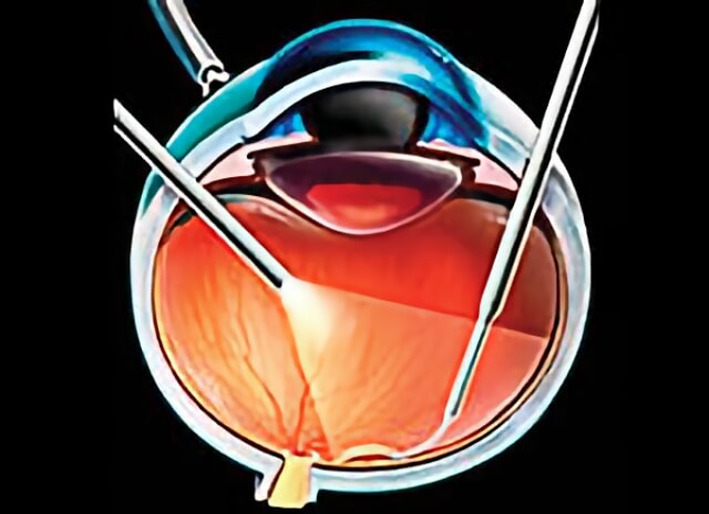 Macular Pucker Treatment Retinal Consultants Medical Group