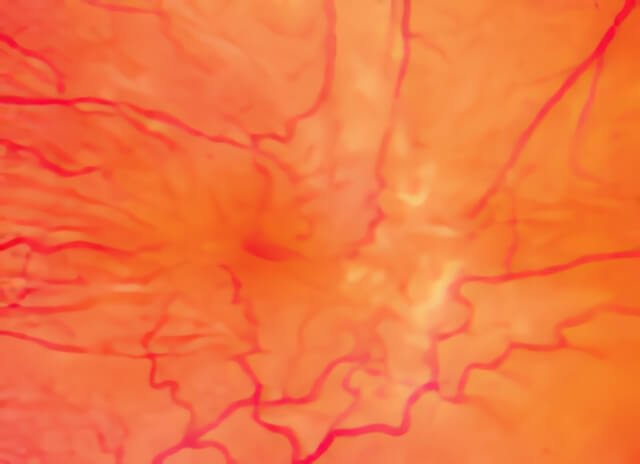 Macular Pucker Treatment Retinal Consultants Medical Group